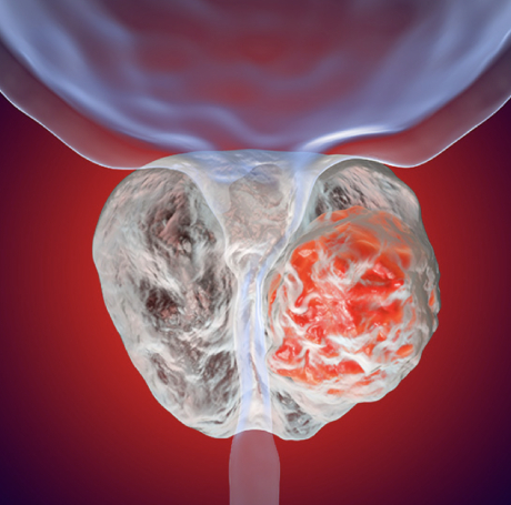 Cáncer de Próstata | Urólogo en Mazatlán